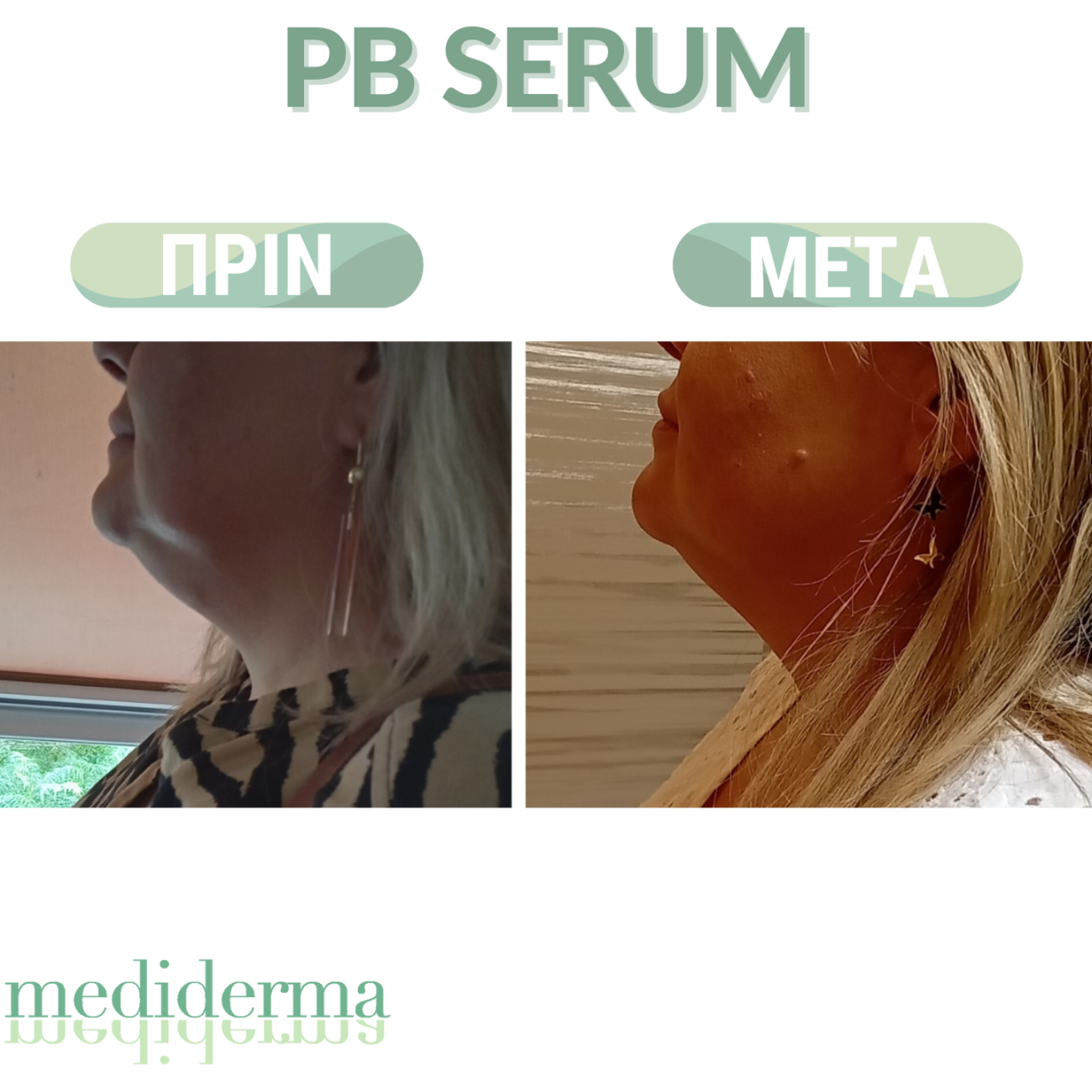 BeforeAfter - Medi Derma