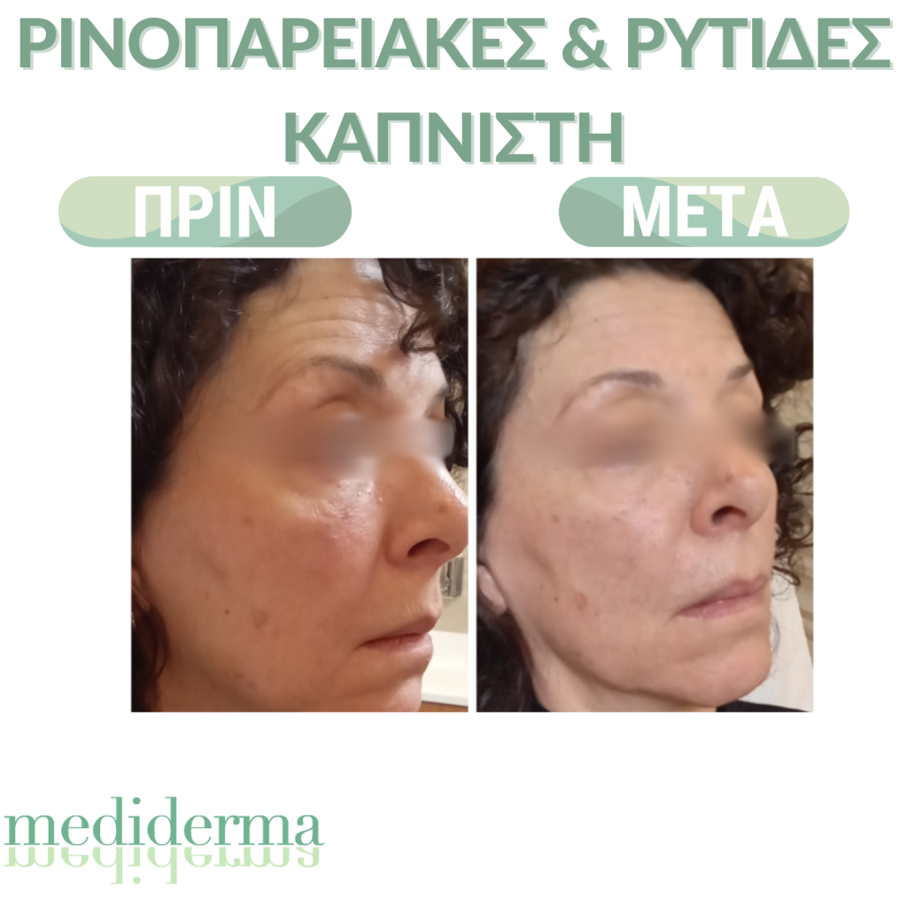 BeforeAfter - Medi Derma